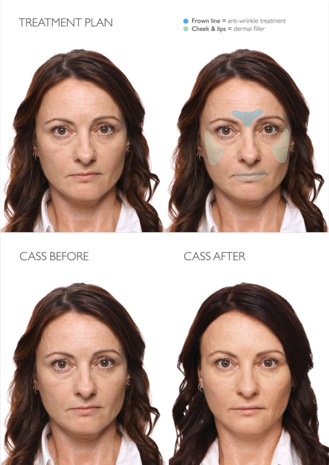 Anti Wrinkle Injection And Dermal Fillers Bioscor Malaysia